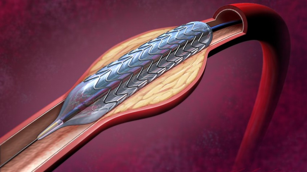 Coronary Stents