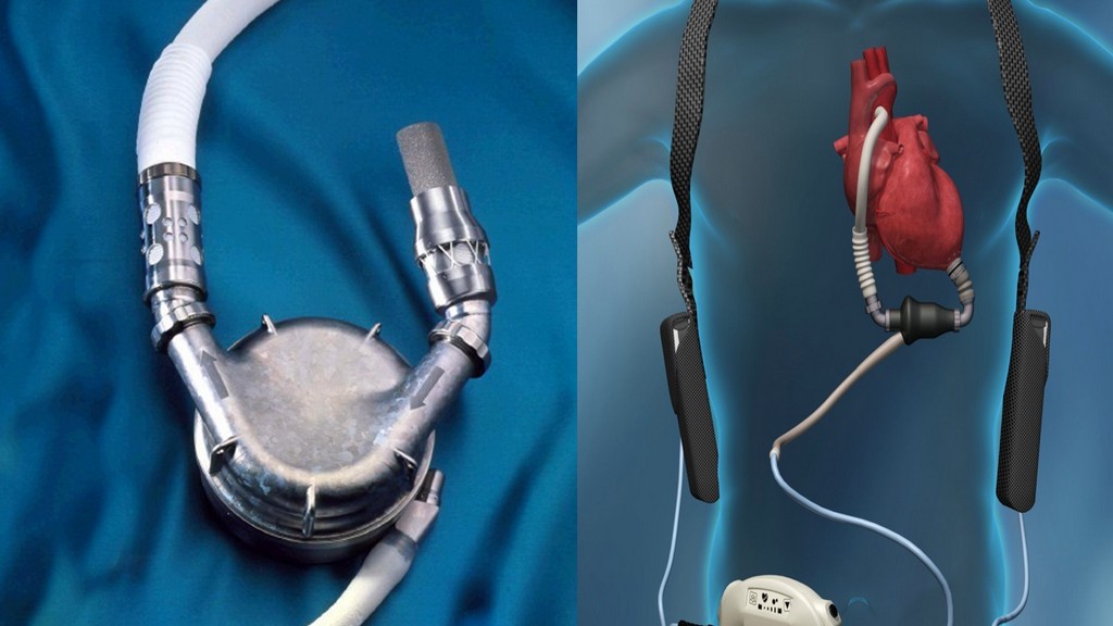 Ventricular Assist Devices